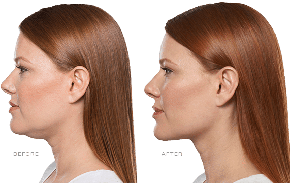 Kybella Injections Specialist Tampa FL | BioDesign Wellness Center