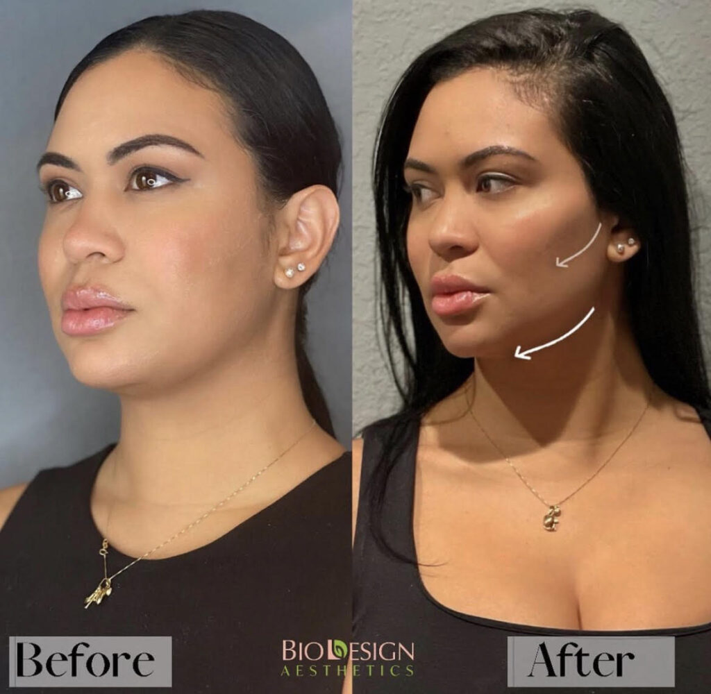 Cheek Enhancement | Tampa