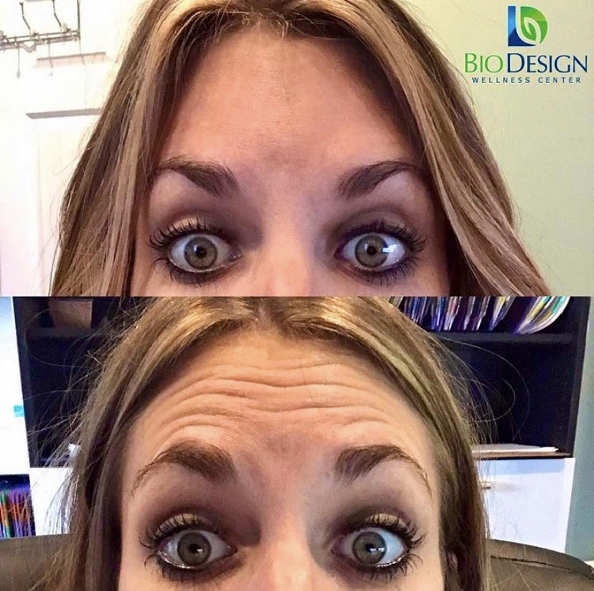 Wrinkles And Fine Lines | Tampa